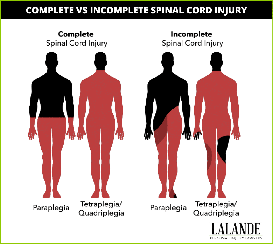 Complete Spinal Cord Injuries | Lalande Personal Injury Lawyers